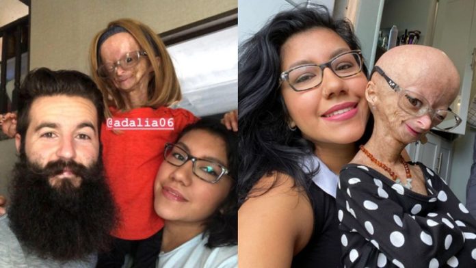 Adalia Rose, YouTube Star with Early-Aging Disorder, Dies at 15 - 92130 ...